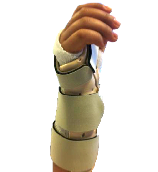 Occupational Therapy for a Broken Wrist